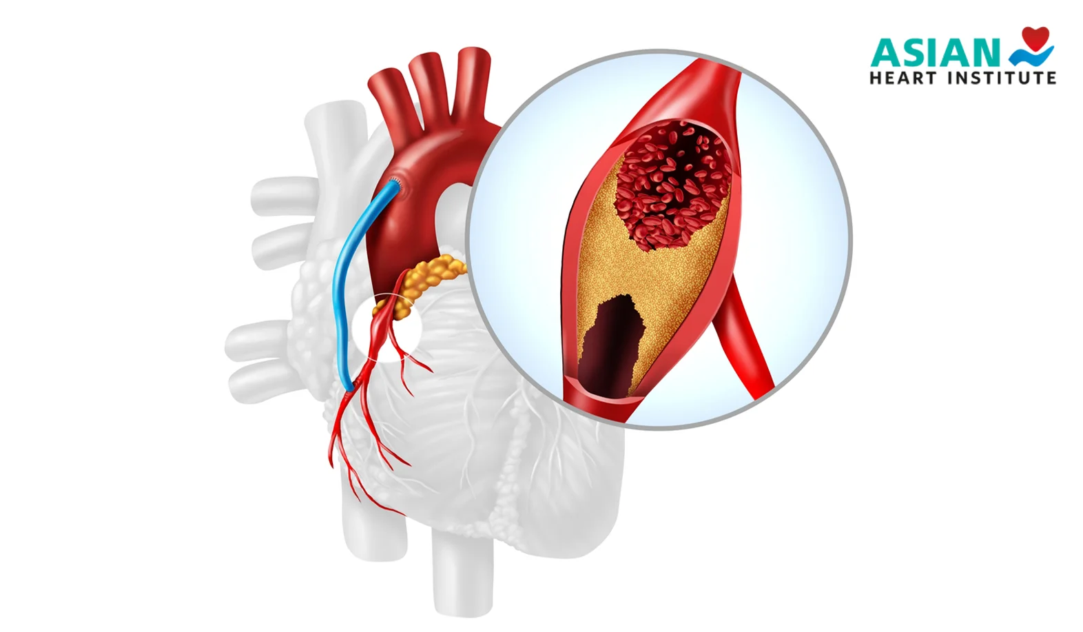 How to Remove Heart Blockage Without Surgery | Natural Remedies