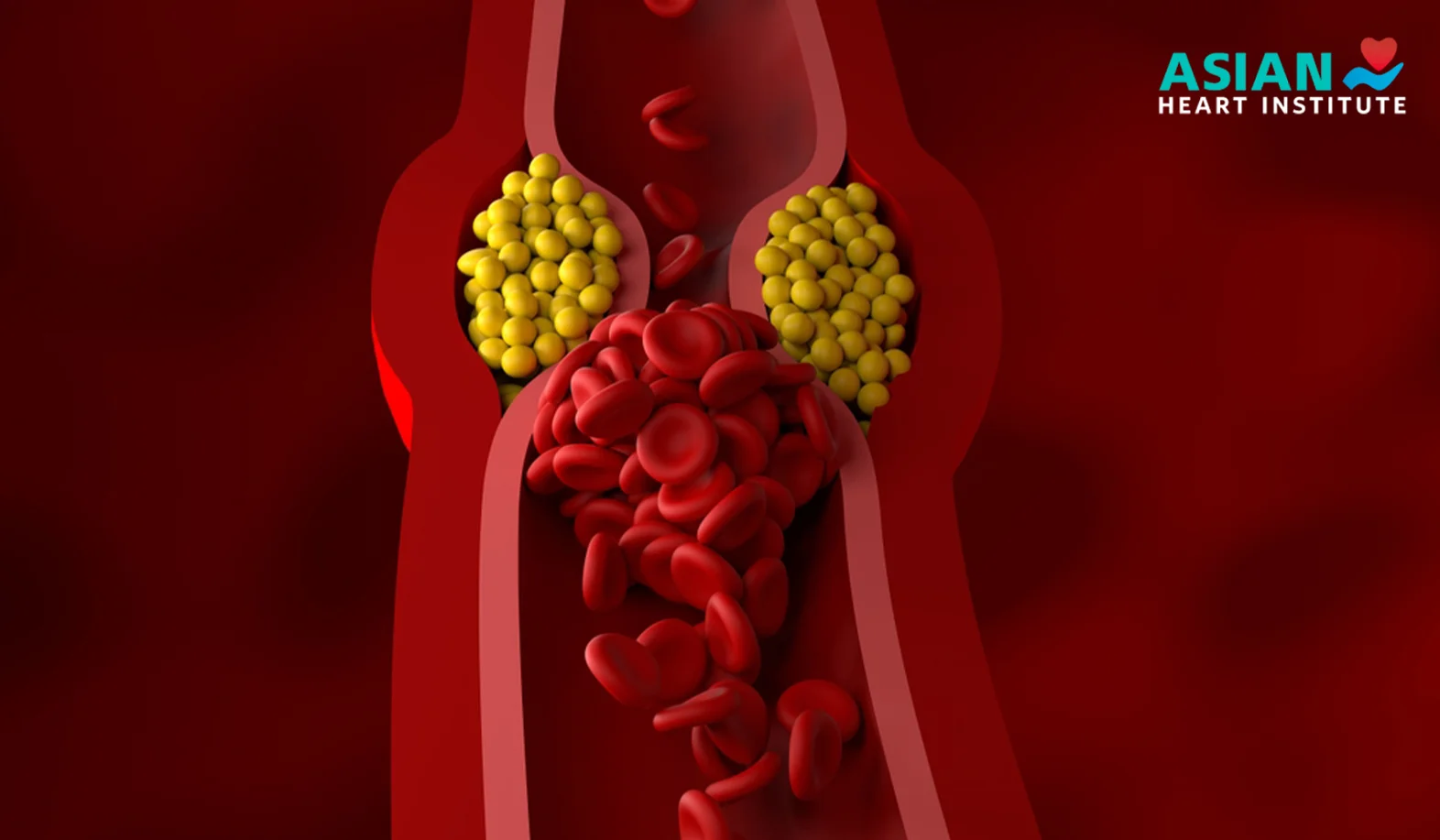 What Are Triglycerides? Symptoms, Causes & How to Treat High Levels